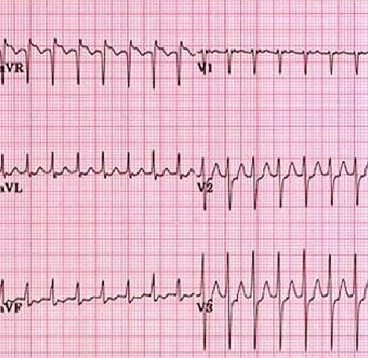Supraventricular Tachycardia